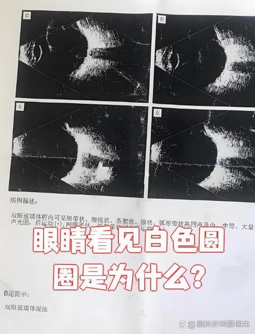 眼睛能看到白色圈圈截图