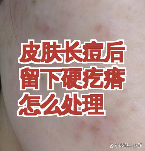 长痘后留下的红色印记
