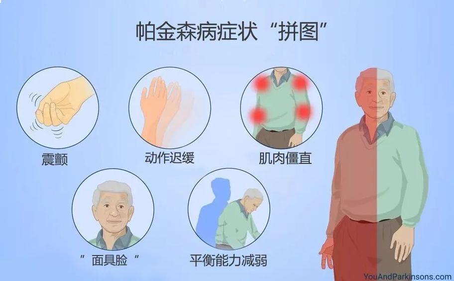 帕金森综合征四大症状图标