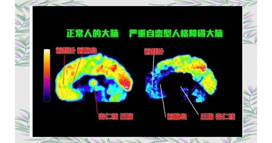 npd属于精神疾病吗图标