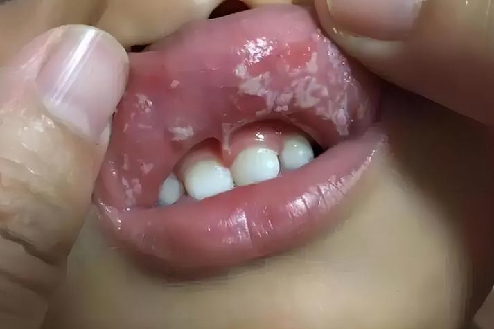 鹅口疮的图片 成人