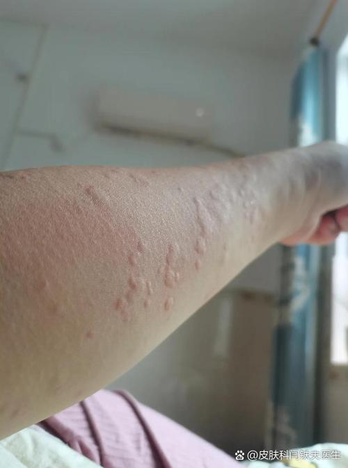胳膊上痒一抓就起疙瘩是怎么回事图标
