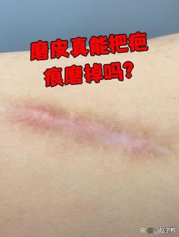 磨皮真能把疤痕磨掉吗图标