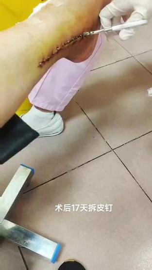 在家怎么自己拆钉皮钉图标