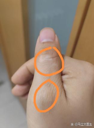 手指皮肤出现白色一片是什么原因截图
