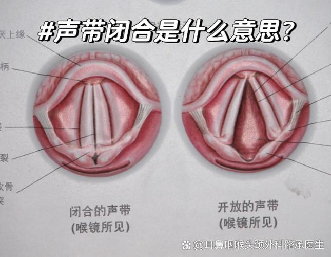 声带闭合不全是什么原因造成的图标