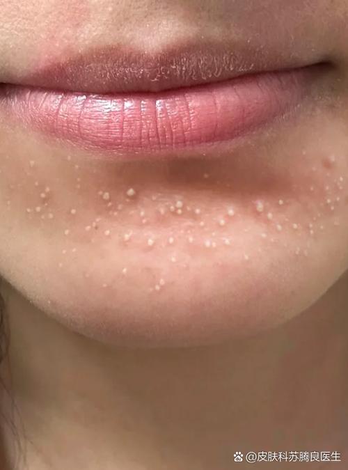 红色痘痘冒白点有脓图标