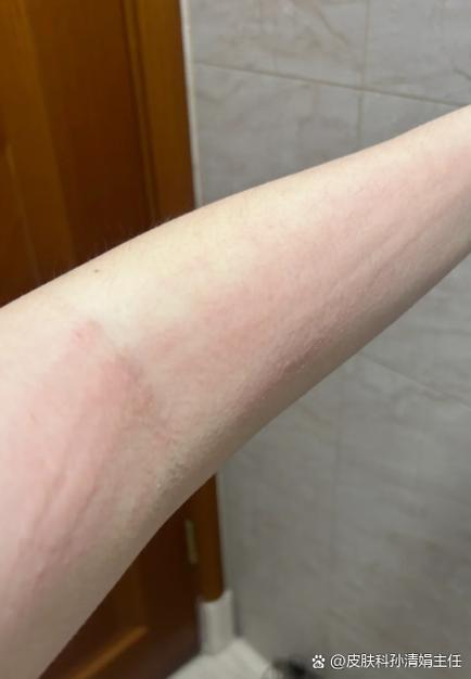 身上痒一挠就起一条条,越挠越痒图标