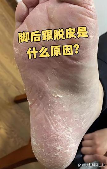 脚脱皮不痒只脱皮图标