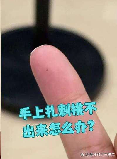 手上扎刺不挑会自愈吗图标