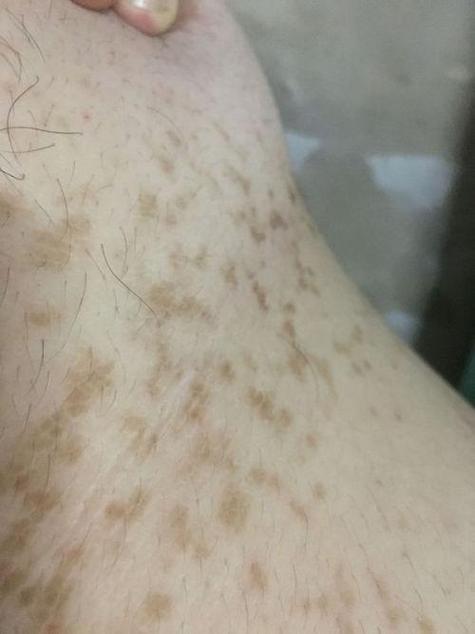 皮肤黑斑的10个图片图标