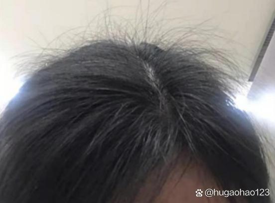 女性脂溢脱发能自愈吗图标