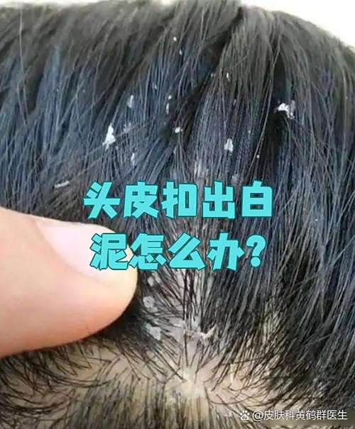 抠头皮会把毛囊抠掉吗