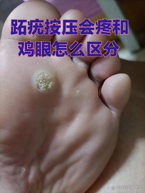 脚上长跖疣怎么治图标