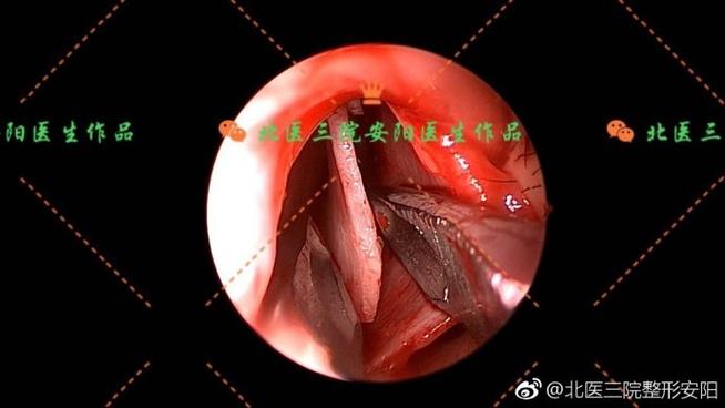 鼻中隔手术全过程视频图标