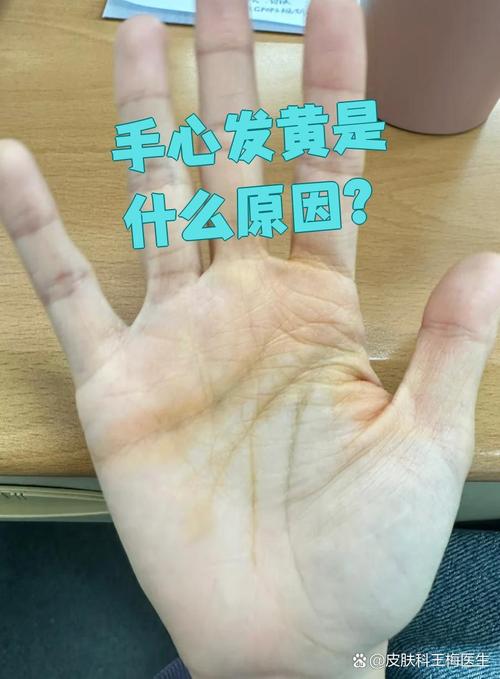 掌心黄梅麻缩略图
