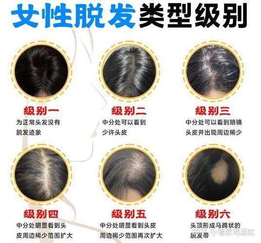 斑秃用激光打头皮好使吗图标