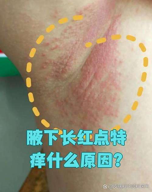 腋下有疙瘩痒怎么回事图标