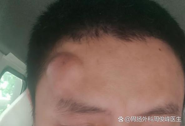 头上撞了个包图片