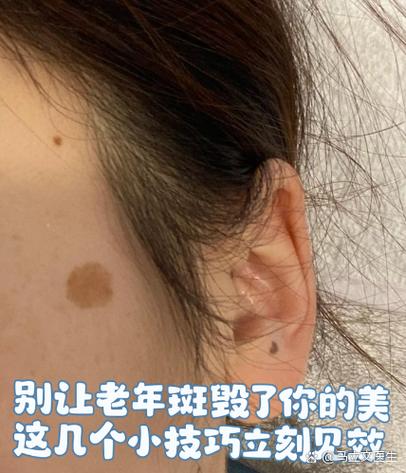 脸上棕色的斑点凸起图标