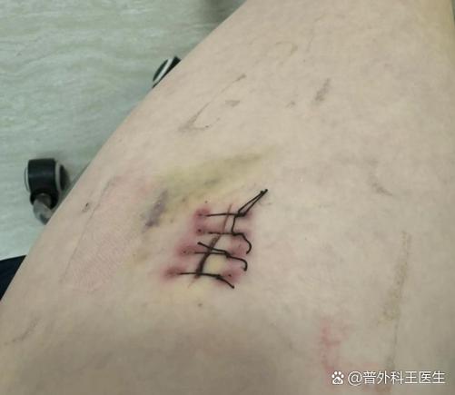 手术后刀疤周围发黑截图