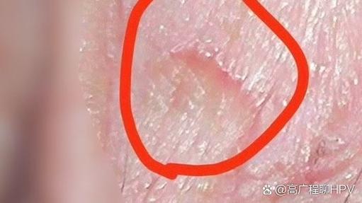 做spa会感染hpv吗图标
