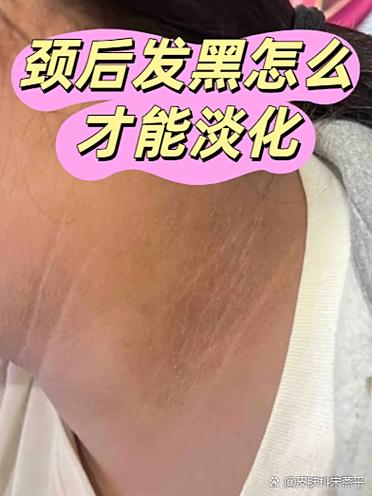 黑棘病的最好治疗方法图标