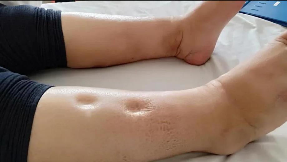 水肿消了体重下降8斤截图