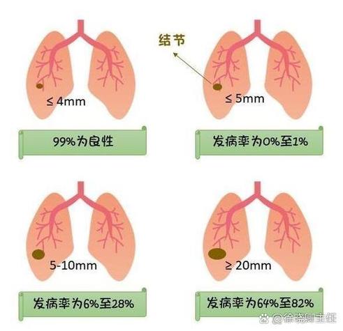肺结节产生的原因图标
