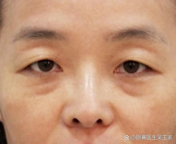 突然一只眼皮往下塌怎么办截图