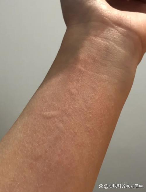 皮肤痒一抓就起小颗粒图标