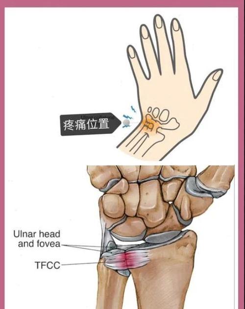 tfcc损伤有什么症状图标
