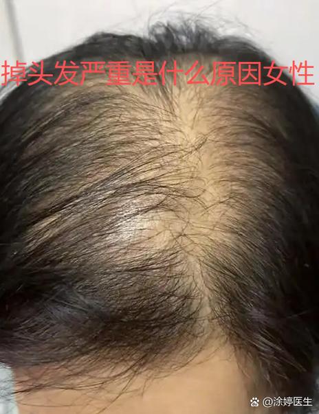 经常掉头发是什么原因女性截图