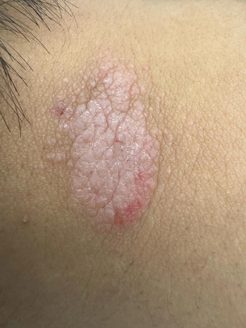 脖子上长了像癣一样东西