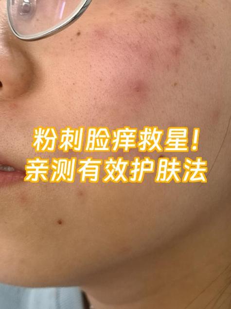 下面出现豆腐渣状而且痒怎么办图标