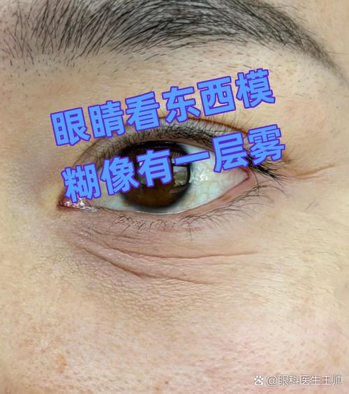 一只眼睛突然模糊看不清像有层雾图标
