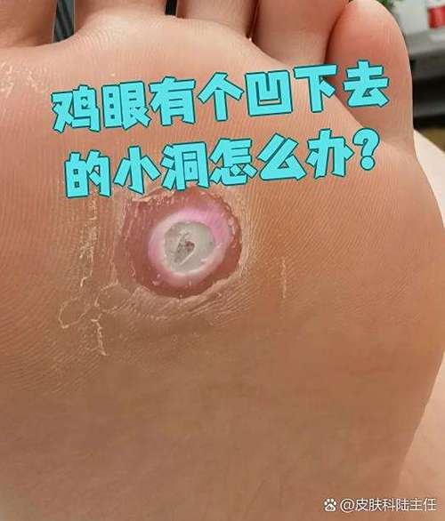 肉刺图片初期图标