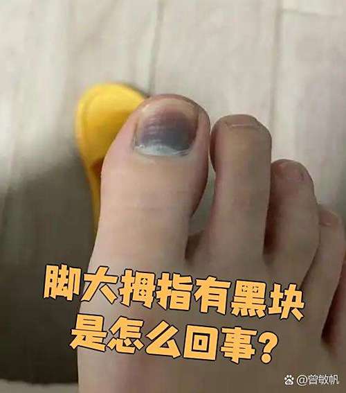 5种脚趾发黑图片图标