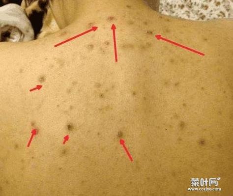 感染螨虫的皮肤图片图标
