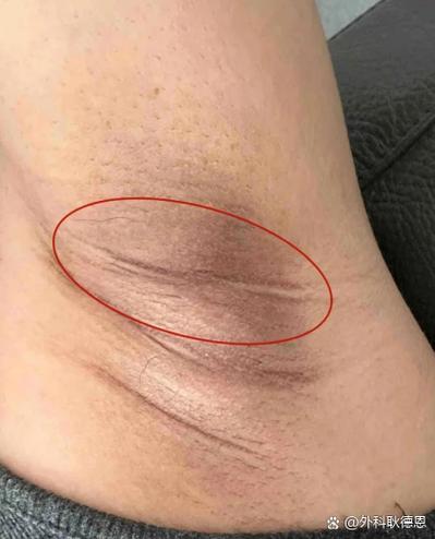 左腋下10公分要警惕