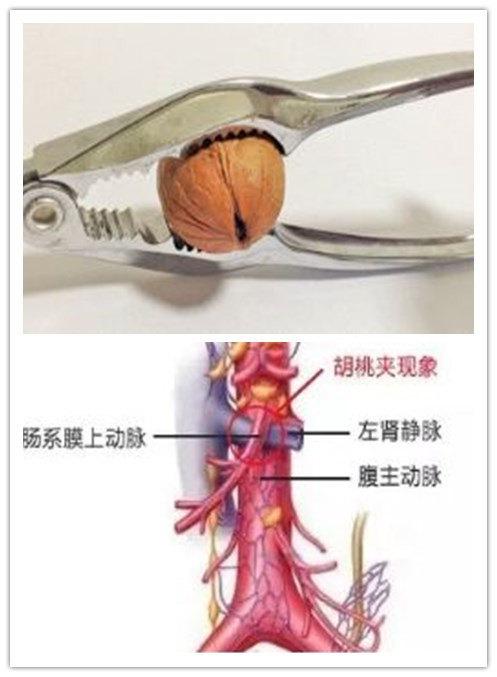 什么情况下是胡桃夹的截图
