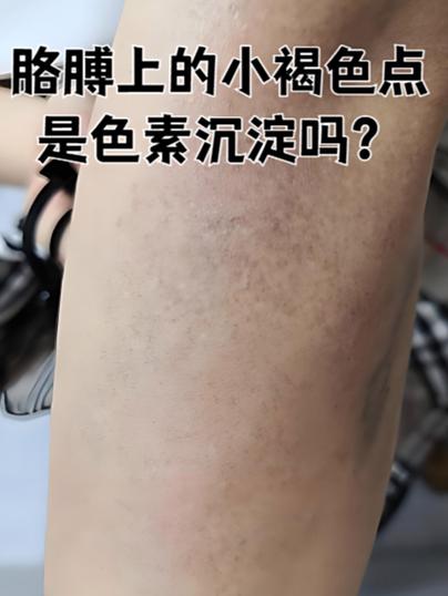 皮肤黑子图片大全图标