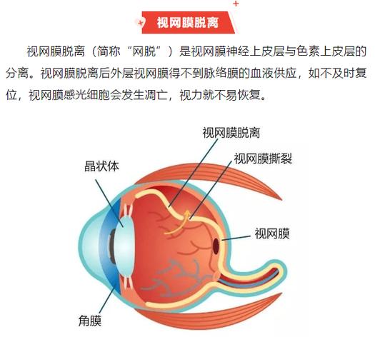 玻璃眼是什么病截图