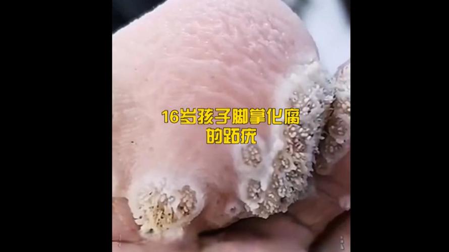 跖疣的根有多深图片缩略图