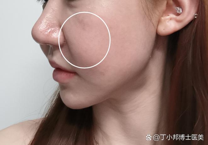 打玻尿酸一年后硬块图图标