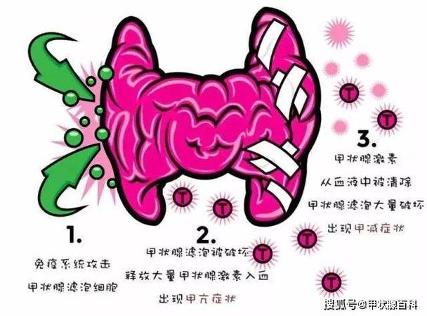桥本是癌症的前兆吗图标