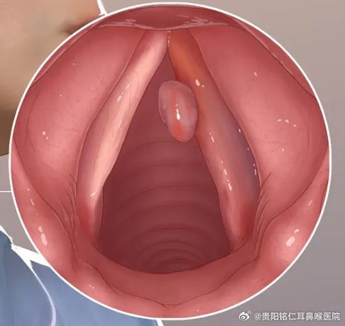 声带坏了最明显的征兆图标