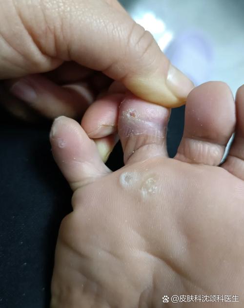 跖疣用什么药膏能治好图标