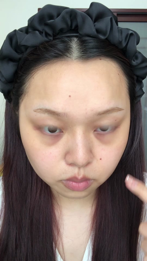 女孩黑眼圈重什么原因造成的