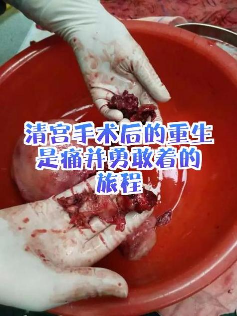 刮宫手术需要多少钱图标